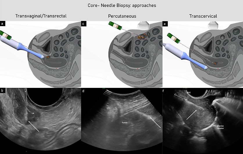 Image-guided Core-needle Biopsy in Gynecological Oncology | Article | GLOWM